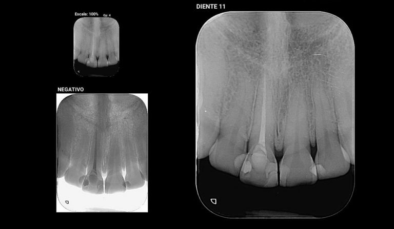 Radiografía Periapical - Dx - Diagnostico Dental