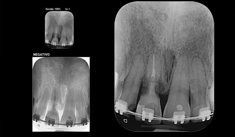 Radiografía Periapical - Dx - Diagnostico Dental