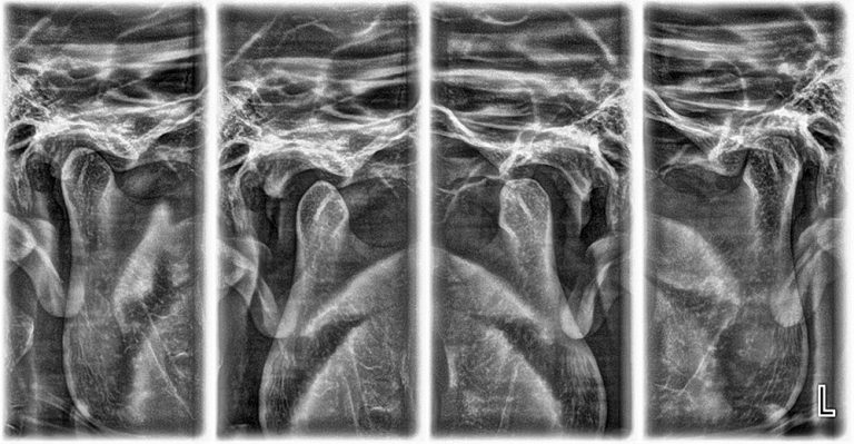 Radiografia ATM - Dx - Diagnostico Dental